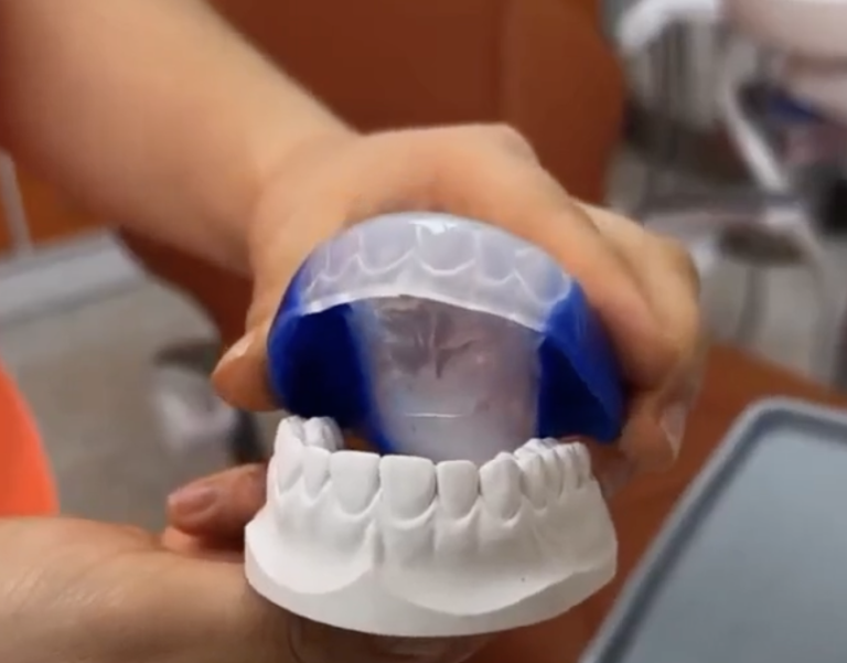 GUARDAS OCLUSALES PROGRAMADAS O FÉRULAS MIORELAJANTES – Hola Salud Oral